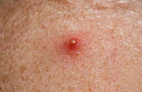 Poussée de boutons soudaine sur le corps qui gratte : que faire ...